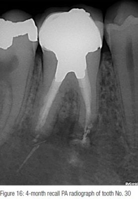Management of a tooth with a large radiolucency: Part 2 - Endodontic ...