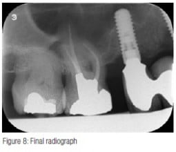 Acute irreversible pulpitis: endodontic management and complicating ...