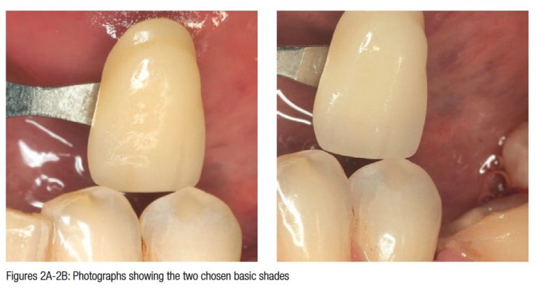 Reconstruction of a tooth with composite endocrown following root canal ...