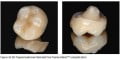 Reconstruction of a tooth with composite endocrown following root canal ...