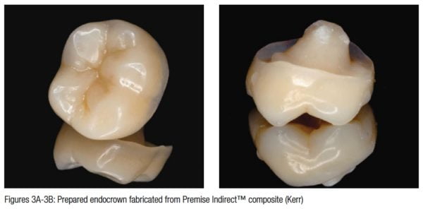 Reconstruction of a tooth with composite endocrown following root canal ...
