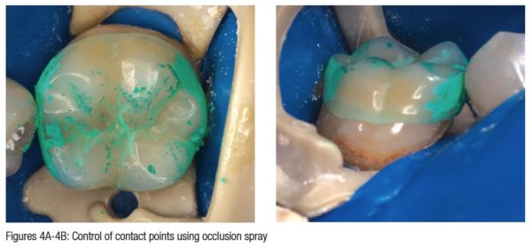 Reconstruction of a tooth with composite endocrown following root canal ...