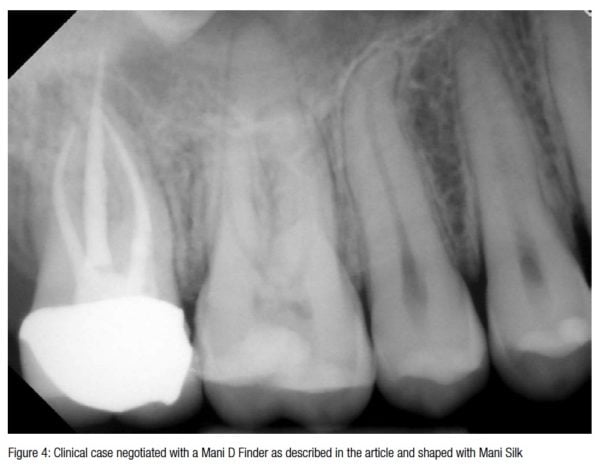 Mani® D Finders: exploring the path - Endodontic Practice US - Dental ...