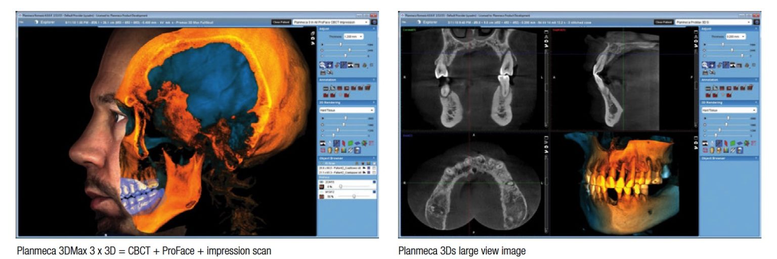 Planmeca Romexis® software - Endodontic Practice US - Dental Journal ...