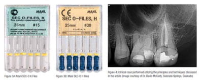 Safe-ended hand files: What, when, how, why - Endodontic Practice US ...