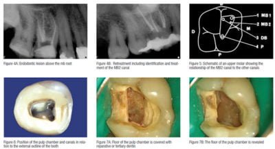 Top ten tips: Tip number 5 – Access cavities and canal location ...