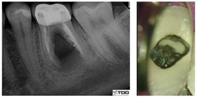 Management of a tooth with a large radiolucency: part 3 - Endodontic ...