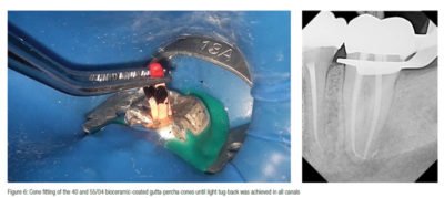 Anatomical shaping with XP 3-D Shaper and Finisher - Endodontic ...