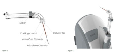 Endodontic News - Apical negative pressure irrigation advances ...