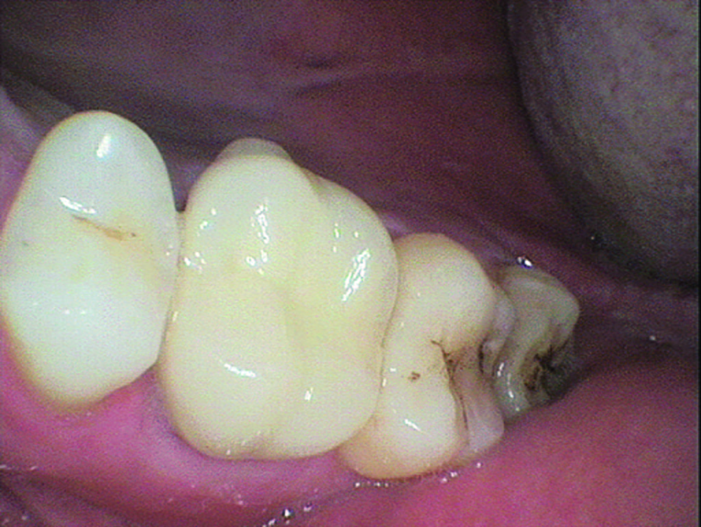 Repair of furcal iatrogenic perforation with MTA – Endodontic Practice ...
