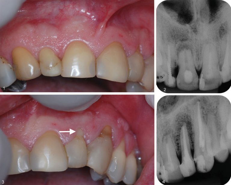 Surgical treatment of persistent apical periodontitis and external root ...
