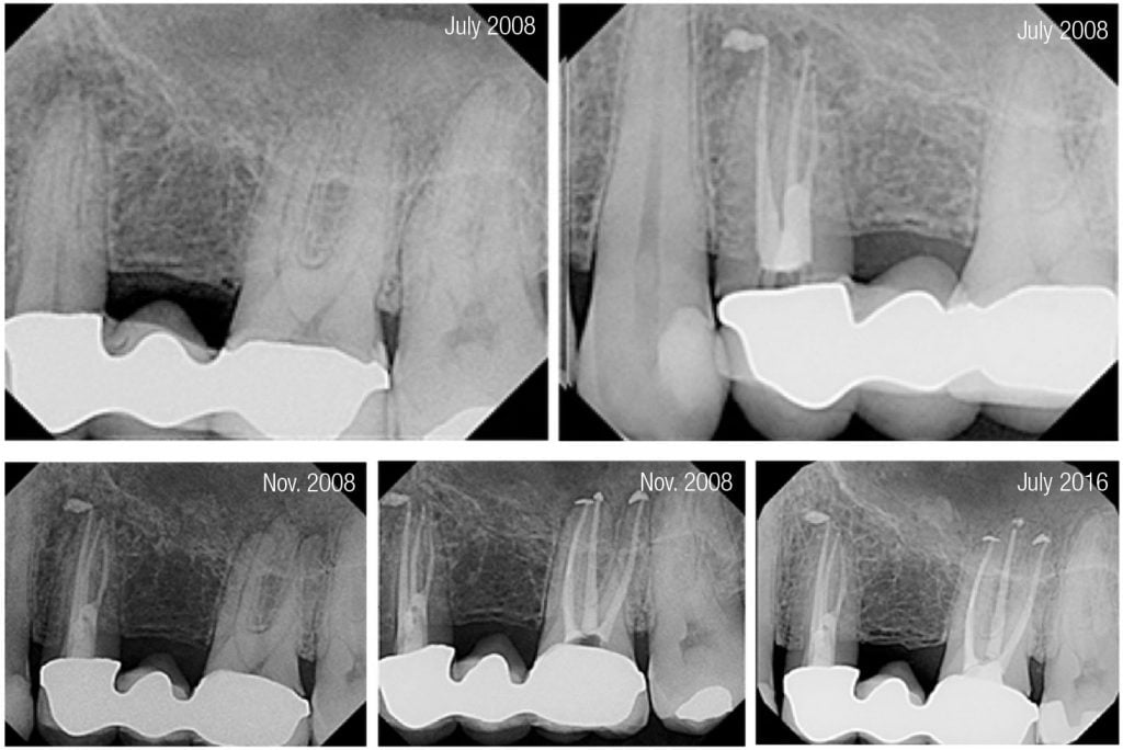 Premixed nanoparticulate bioceramics in endodontics: the first decade ...
