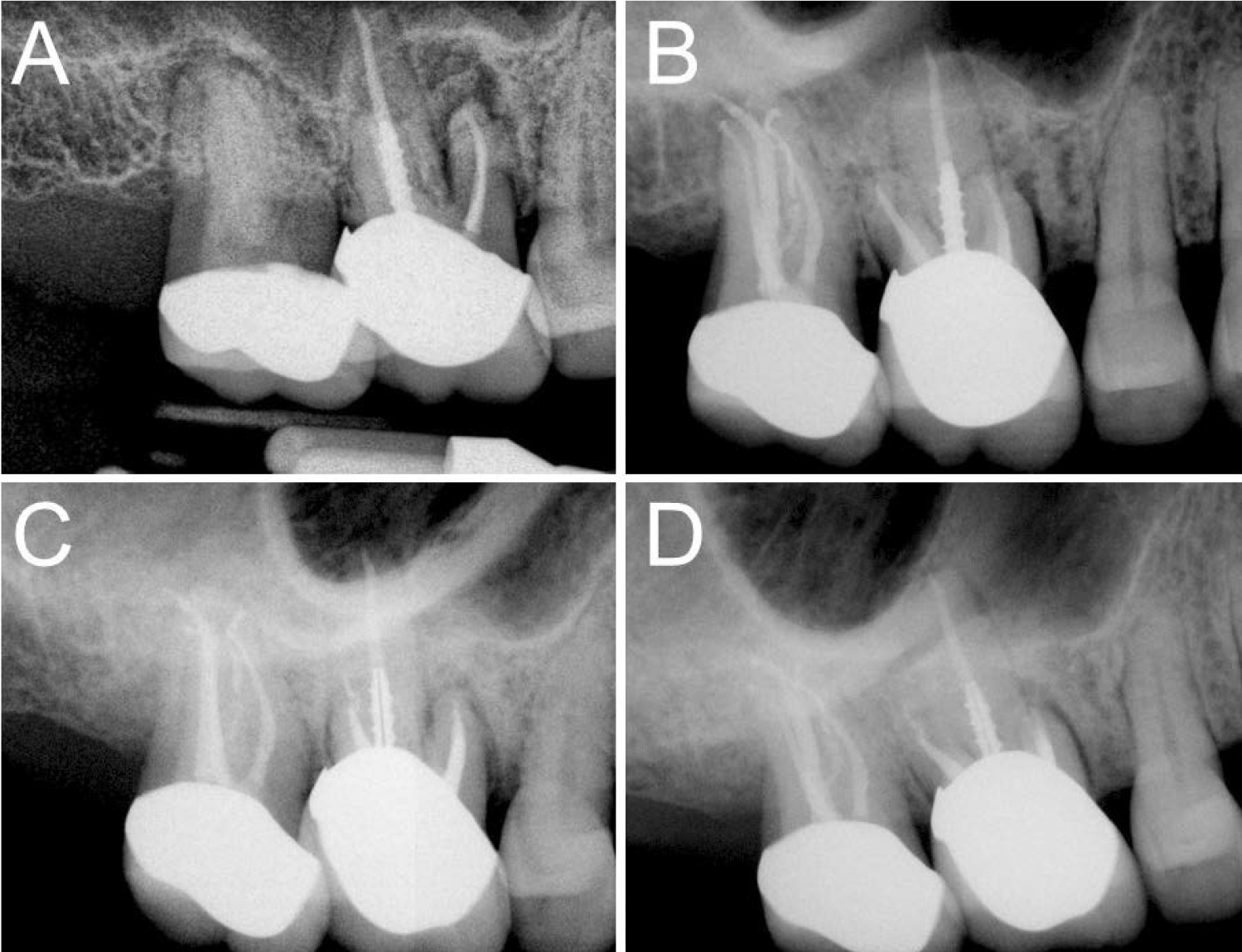Healing Of Apical Periodontitis In A Maxillary Second Molar With Fused Healing Of Apical Periodontitis In A Maxillary Second Molar With Fused
