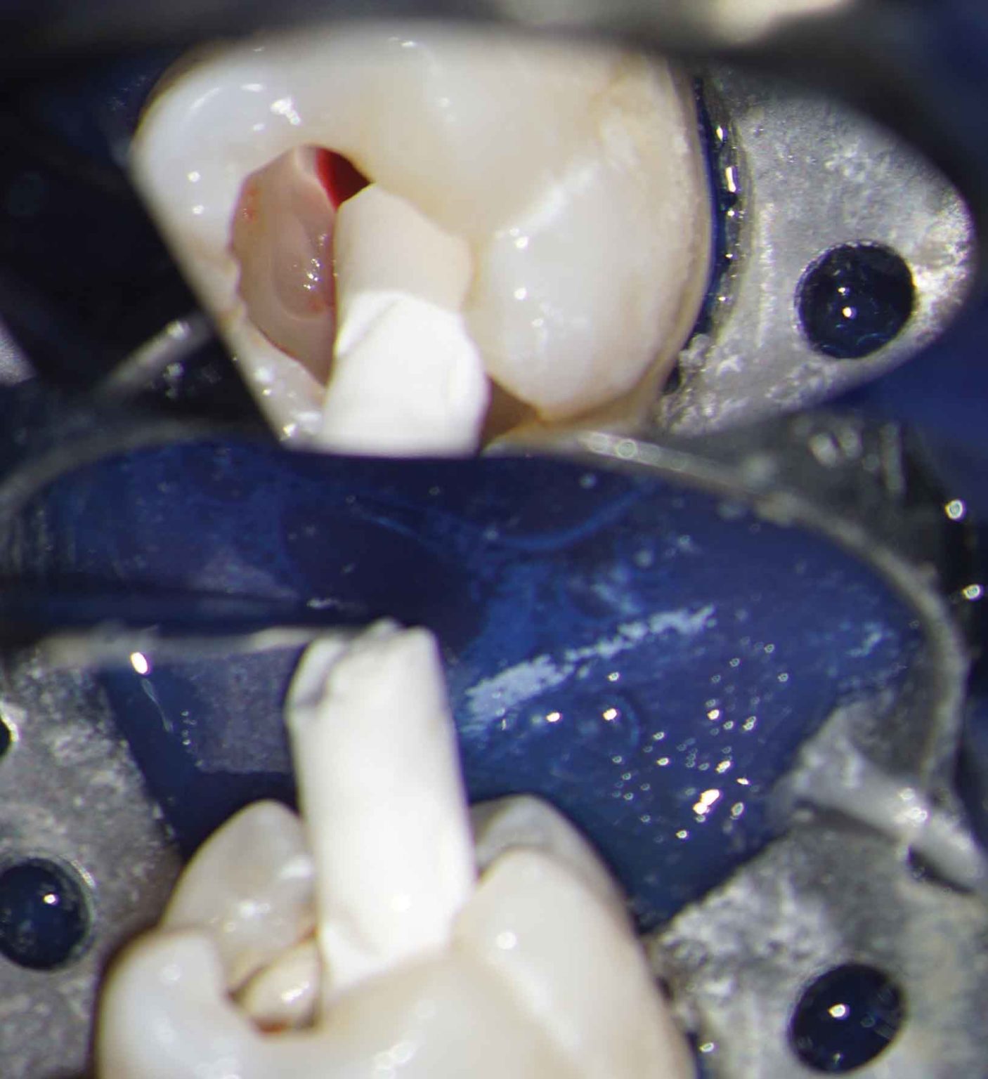 How vital pulp cryotherapy can be used in the endodontic practice ...