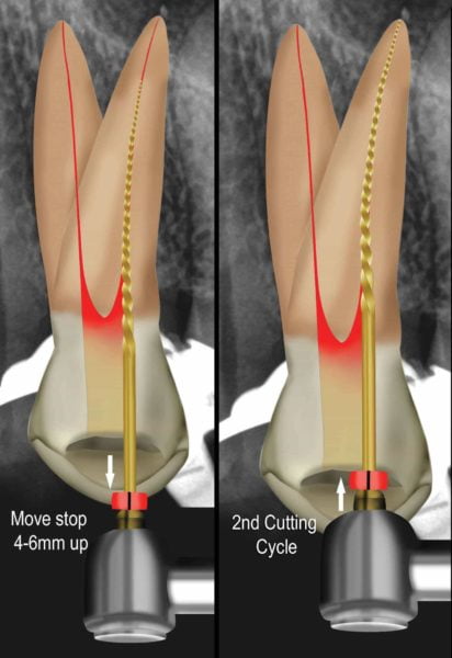 Ways to use WaveOne® Gold reciprocating instruments | Endodontic ...