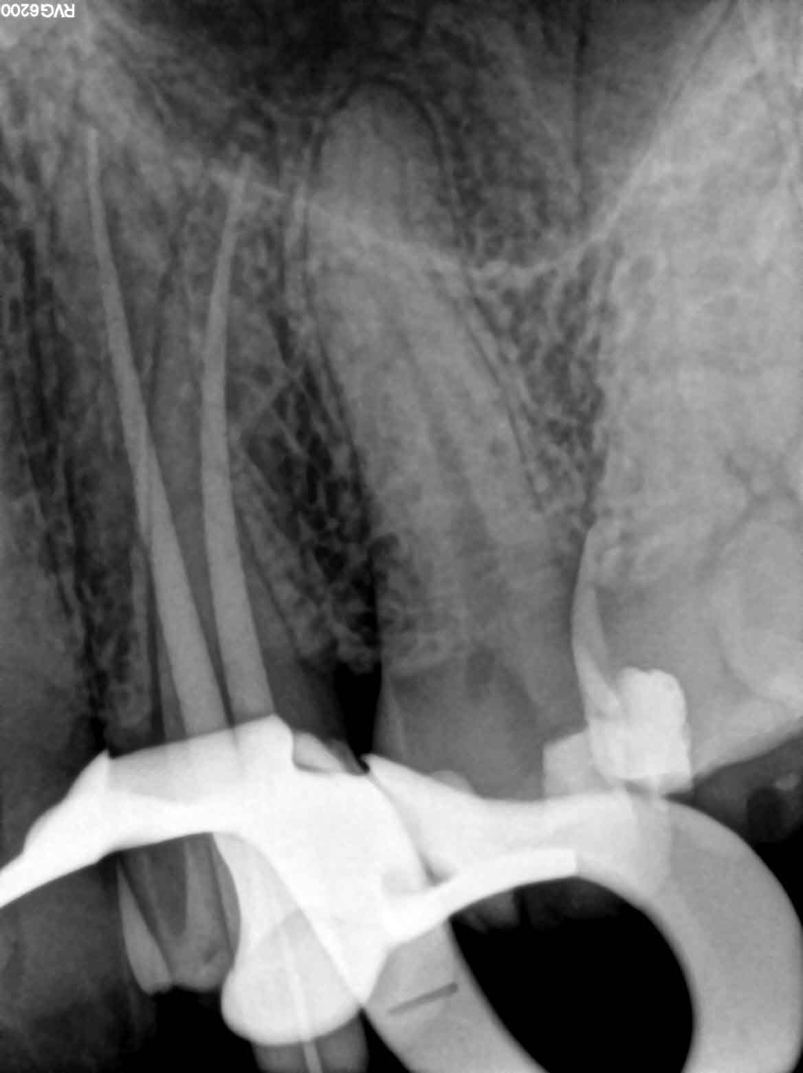 Ways to use WaveOne® Gold reciprocating instruments | Endodontic ...