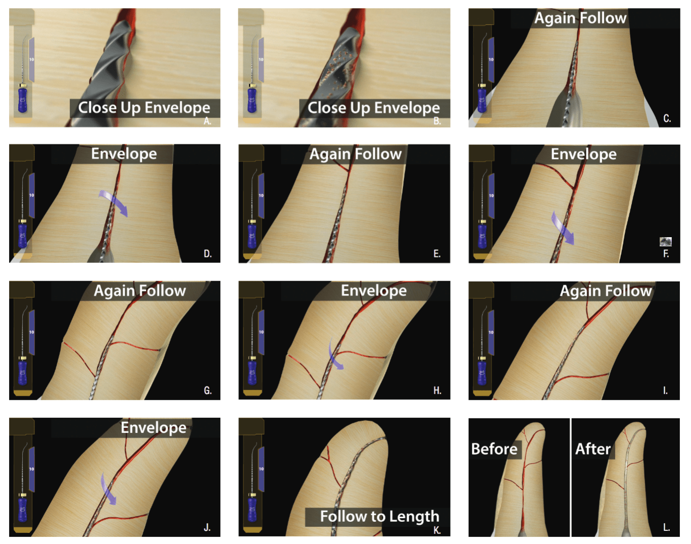 Restraint is an essential element in endodontic treatment | Endodontic ...
