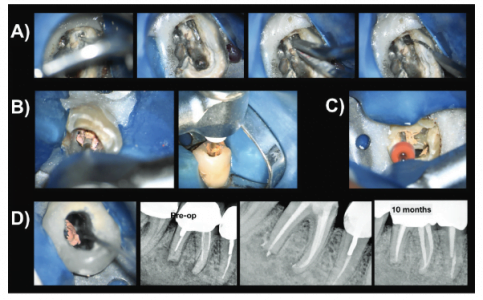 Avoiding retreatment failure through correct endodontic and restorative ...