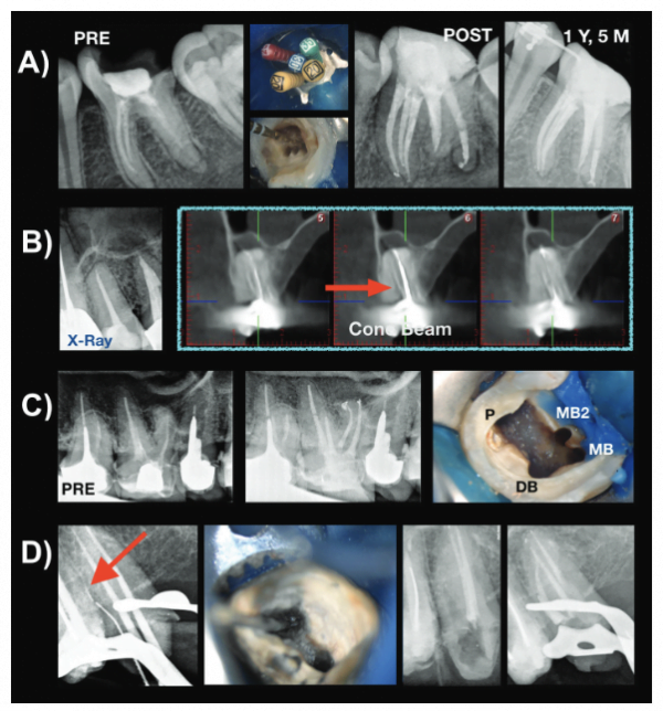 Avoiding retreatment failure through correct endodontic and restorative ...