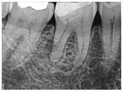 Treatment and maintenance of an external inflammatory root resorption