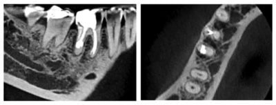 Treatment and maintenance of an external inflammatory root resorption