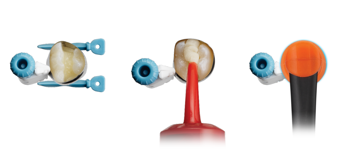 Endodontic News - Dentsply Sirona’s new Surefil one: An innovation in ...