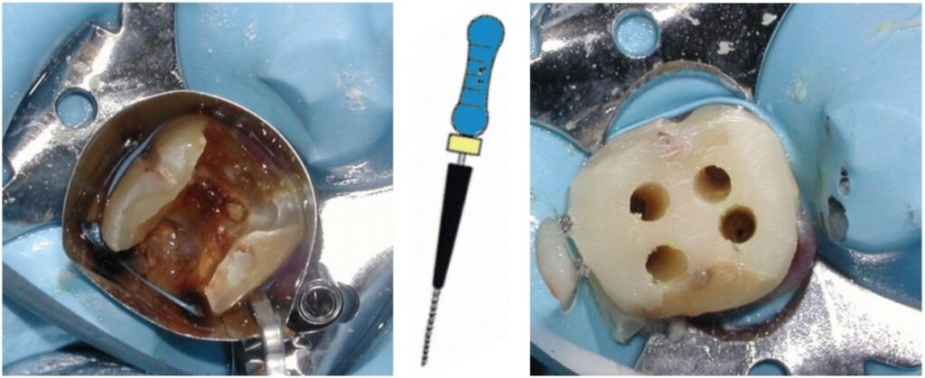 Mitigation of coronal leakage