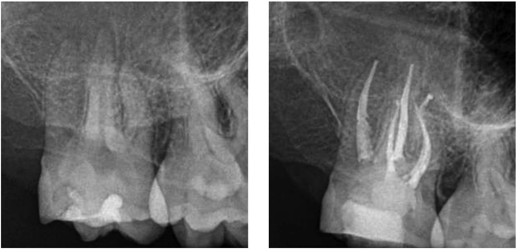 Non-surgical endodontic treatment — evidence-based strategies