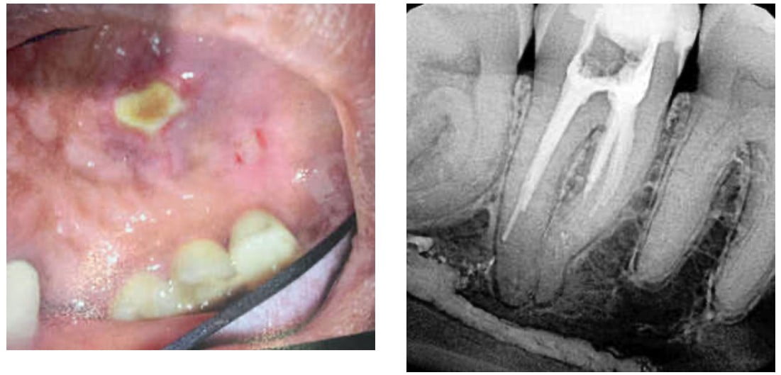 Non-surgical endodontic treatment — evidence-based strategies