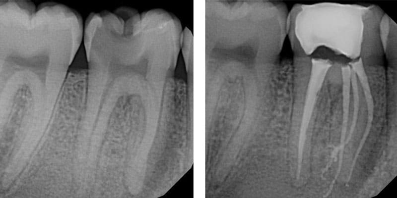 Bioceramic sealers — a promising option in endodontics