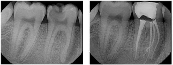 Bioceramic sealers — a promising option in endodontics