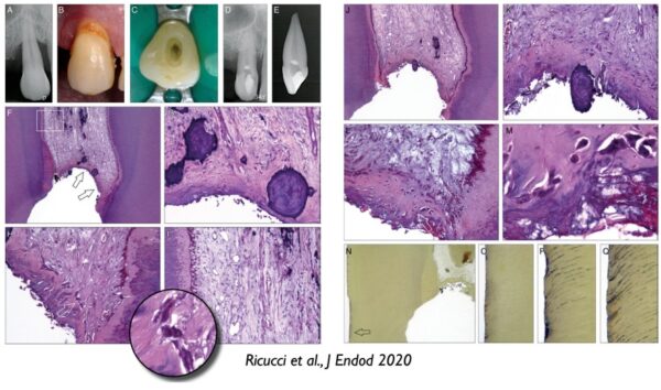 Bioceramics webinar — research and new outcomes