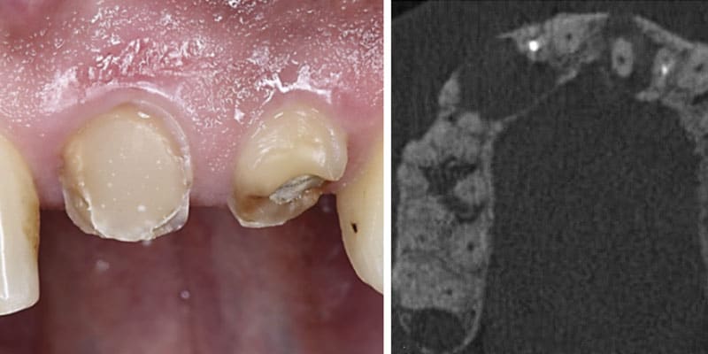 Bioceramics — helpful in bone healing