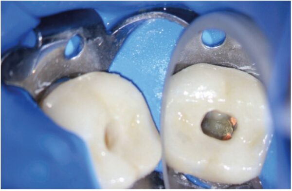 ExactTaperH DC™ — a new endodontic file system