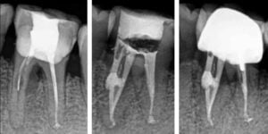 Internal root resorption — a unique entity