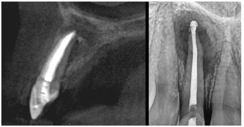 GentleWave — minimally invasive treatment achieved!