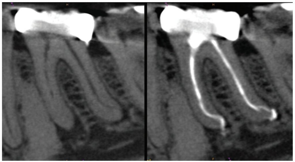 GentleWave — minimally invasive treatment achieved!