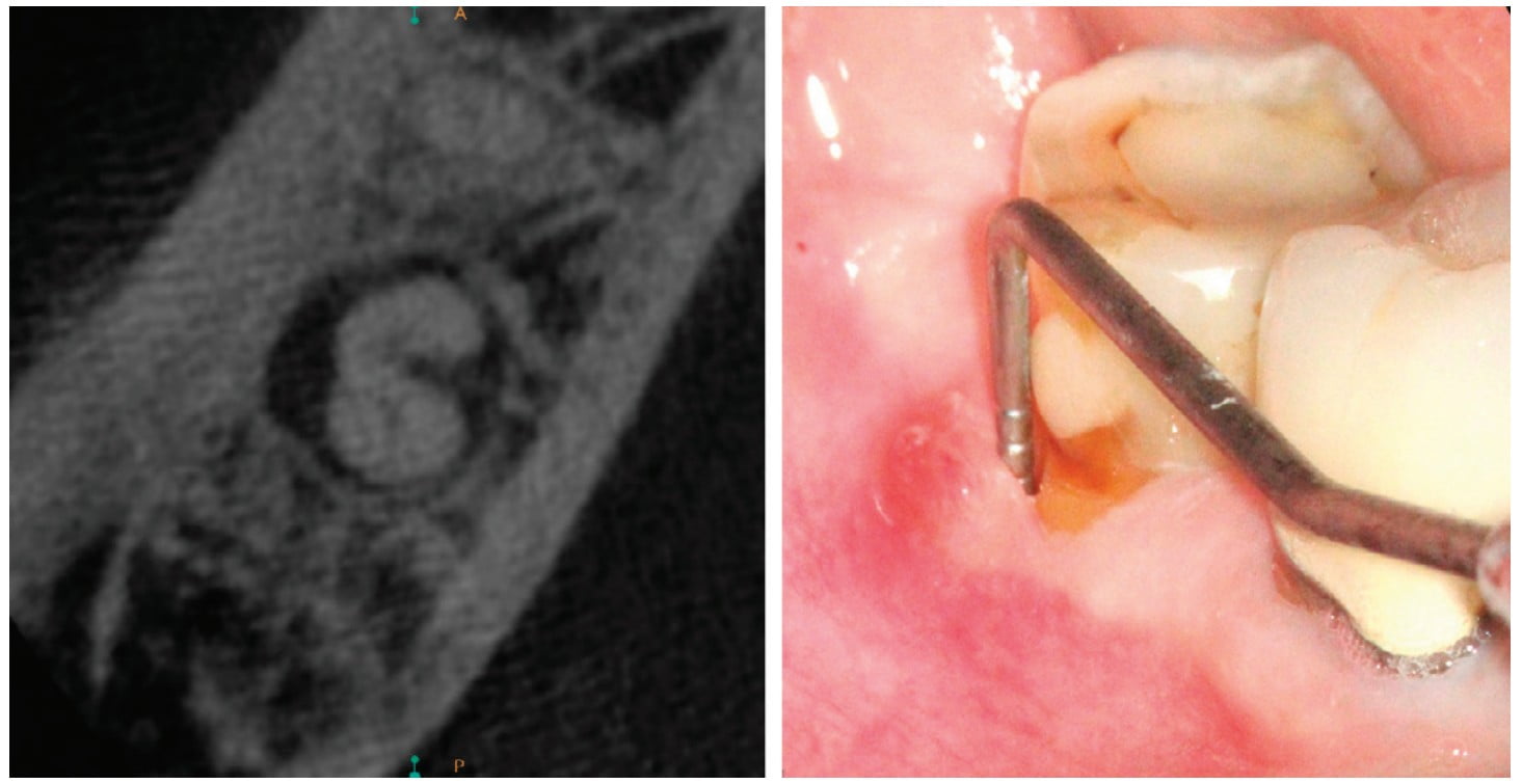 GentleWave — minimally invasive treatment achieved!