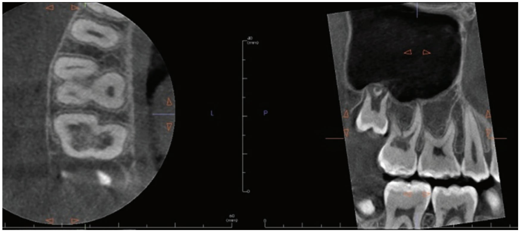 CBCT imaging — avoiding misdiagnosis
