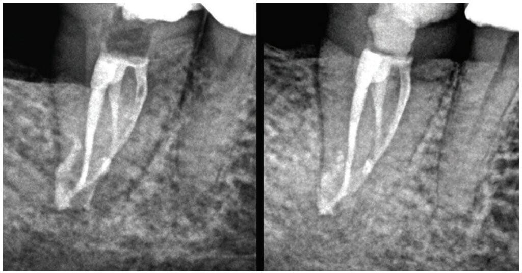 GentleWave — minimally invasive treatment achieved!