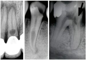 Internal root resorption — a unique entity