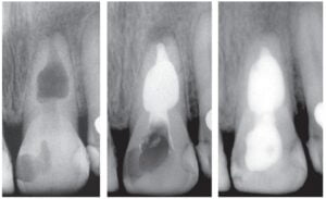 Internal root resorption — a unique entity
