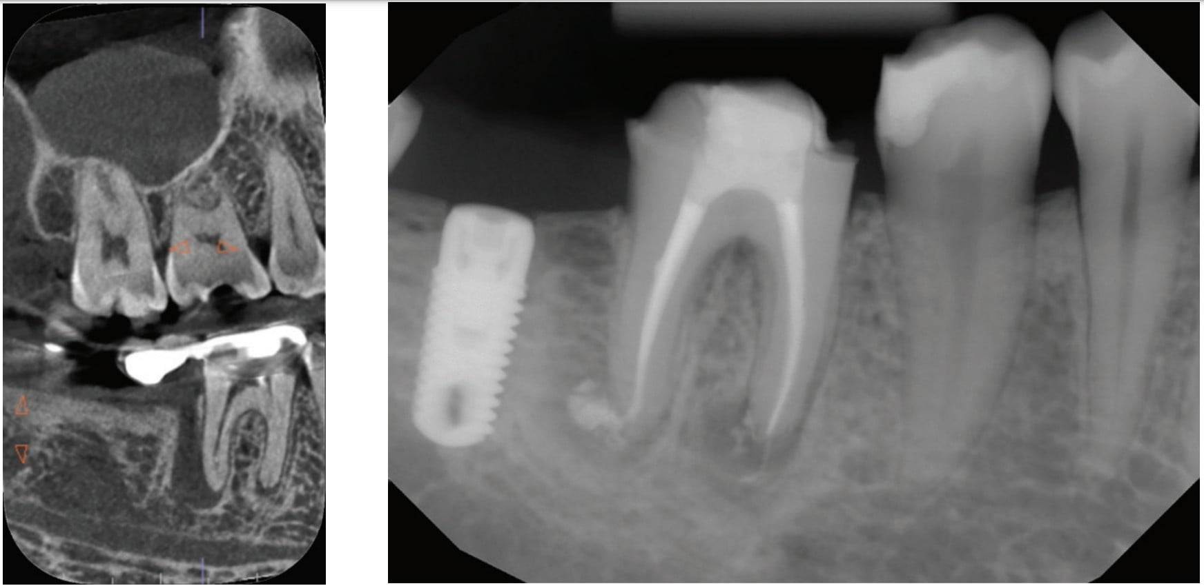 CBCT imaging — avoiding misdiagnosis
