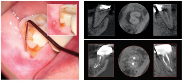 GentleWave — minimally invasive treatment achieved!
