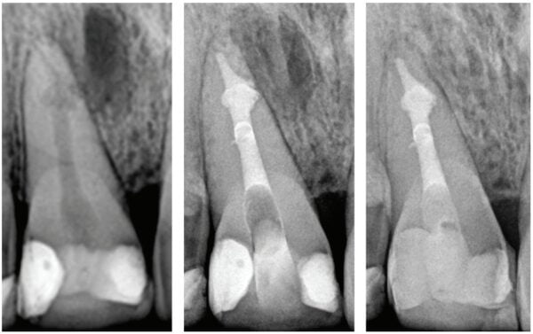 Internal root resorption — a unique entity