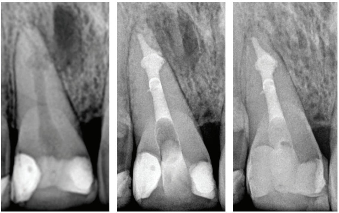 Internal root resorption — a unique entity