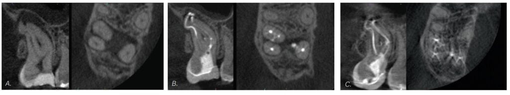 GentleWave — minimally invasive treatment achieved!