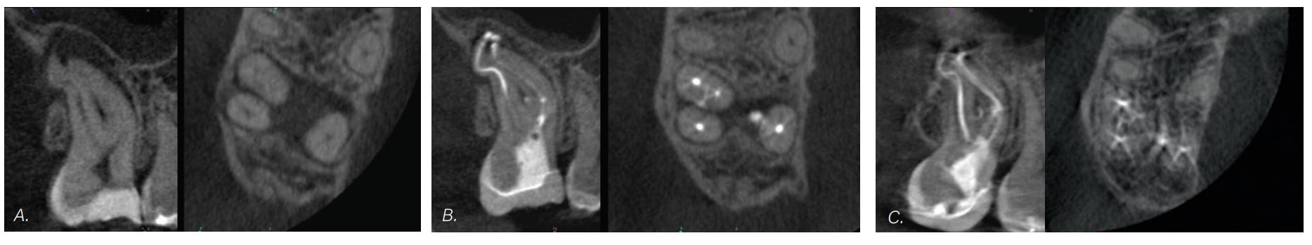 GentleWave — minimally invasive treatment achieved!