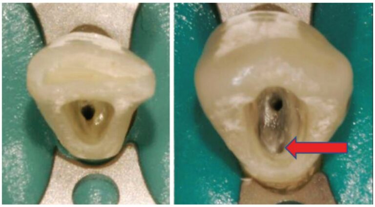 Preserving tooth structure — key when accessing canals