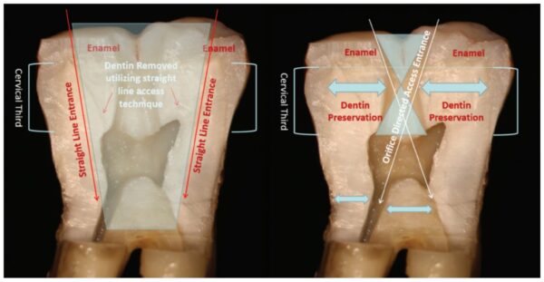 Preserving tooth structure — key when accessing canals